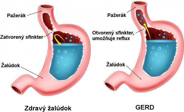 Gastroezofageálny reflux - príznaky, strava, liečba | Zdravovek